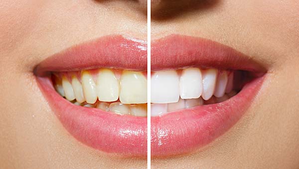 Invisalign Houston Texas | Design Dental Group